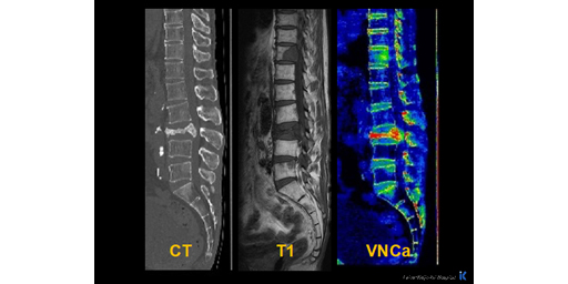 転移性脊椎腫瘍におけるDual Energy CTを用いた物質弁別画像の有用性 | 映像情報Medical