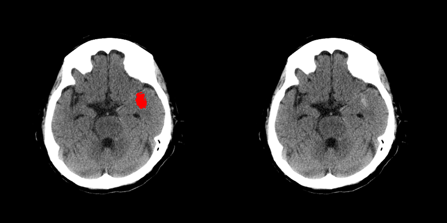 エルピクセル、EIRL Brain Segmentation、頭部CT画像から高吸収／低吸収領域及び組織構造・境界の不明瞭化がみられる領域の ...