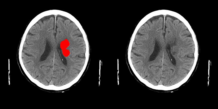 エルピクセル、EIRL Brain Segmentation、頭部CT画像から高吸収／低吸収領域及び組織構造・境界の不明瞭化がみられる領域の ...