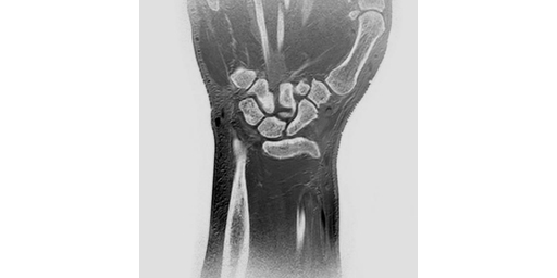 MRIを用いたCT-like imageによる整形外科術前シミュレーション | 映像情報Medical