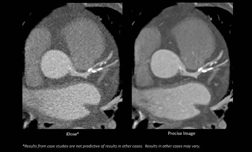 フィリップス、「心不全パンデミック時代」に備える心臓AI技術搭載 最新プレミアムモデル「CT 5300」4月4日(木)より発売 リアルタイムで ...