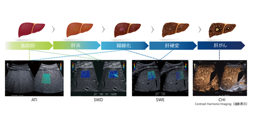 キヤノンメディカルシステムズ、超音波診断装置「Aplio iシリーズ」のアプリケーション「Liver Package」による非侵襲的な肝臓の ...