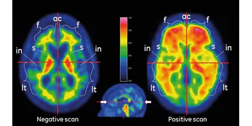GEヘルスケア・ジャパンのPET検査用薬剤合成装置「FASTlab」および「FASTlab 2」で合成されるアミロイドPETイメージング剤 ...