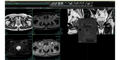 富士フイルム、AIプラットフォーム「SYNAPSE SAI viewer Ver2.7」提供開始～MRI画像向け読影支援機能の拡充とCT縦隔 ...