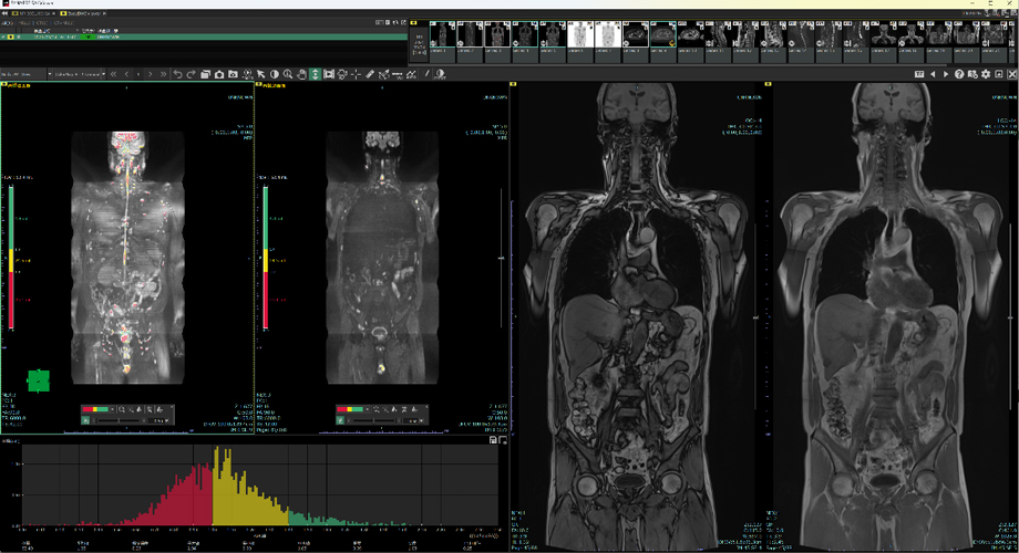 富士フイルム、AIプラットフォーム「SYNAPSE SAI viewer Ver2.7」提供開始～MRI画像向け読影支援機能の拡充とCT縦隔 ...